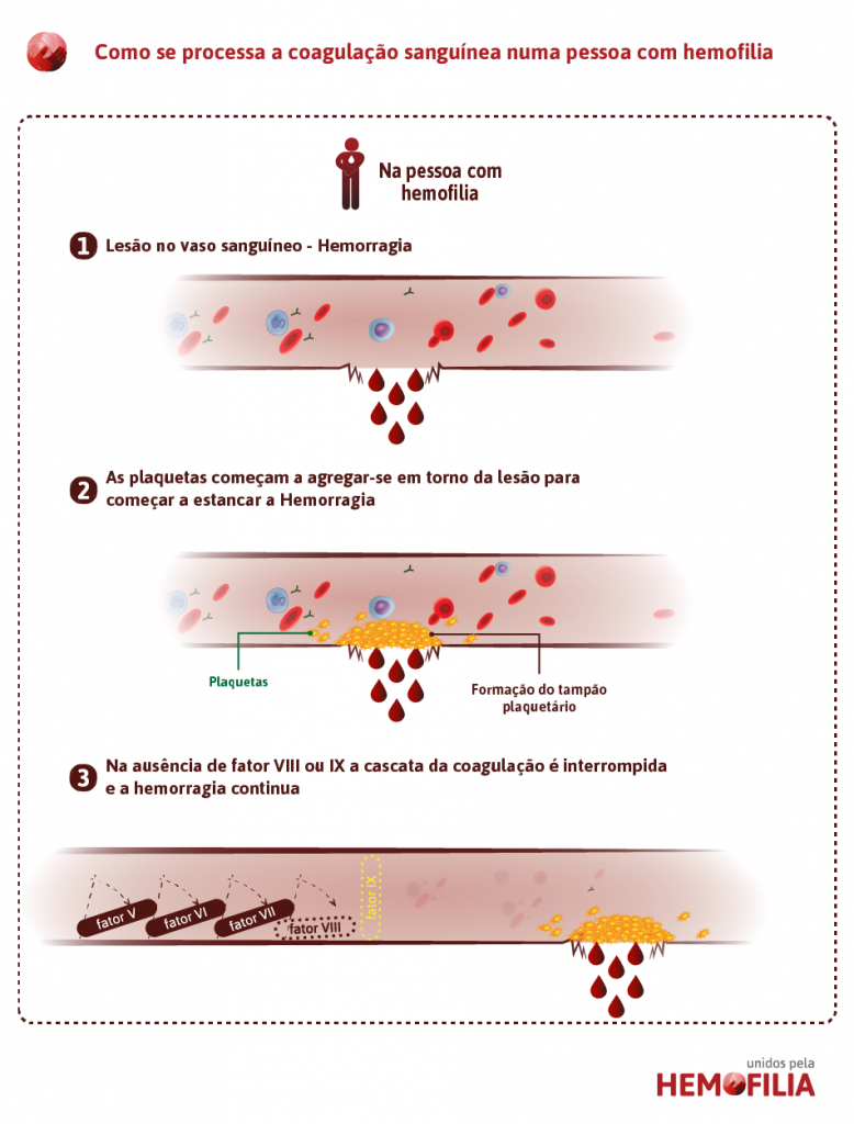 Como-se-processa-a-coagulacao-num-individuo-com-hemofilia | Unidos pela ...
